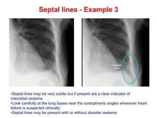 CHEST X-RAY CARDIAC DISEASE.........pptx