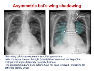 CHEST X-RAY CARDIAC DISEASE.........pptx