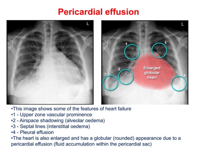 CHEST X-RAY CARDIAC DISEASE.........pptx