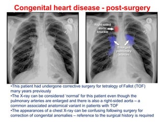 CHEST X-RAY CARDIAC DISEASE.........pptx