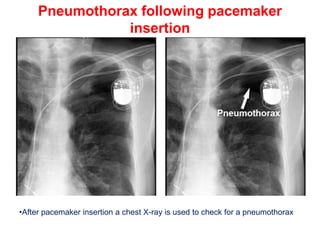 CHEST X-RAY CARDIAC DISEASE.........pptx
