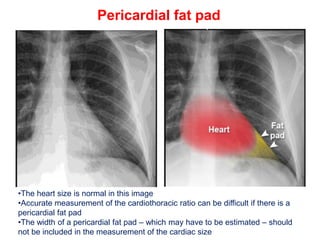 CHEST X-RAY CARDIAC DISEASE.........pptx