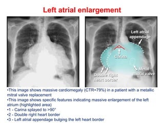 CHEST X-RAY CARDIAC DISEASE.........pptx
