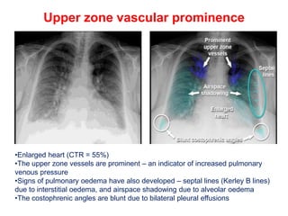 CHEST X-RAY CARDIAC DISEASE.........pptx