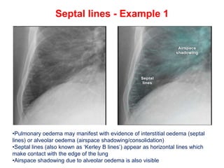 CHEST X-RAY CARDIAC DISEASE.........pptx