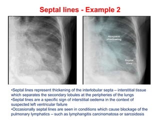 CHEST X-RAY CARDIAC DISEASE.........pptx