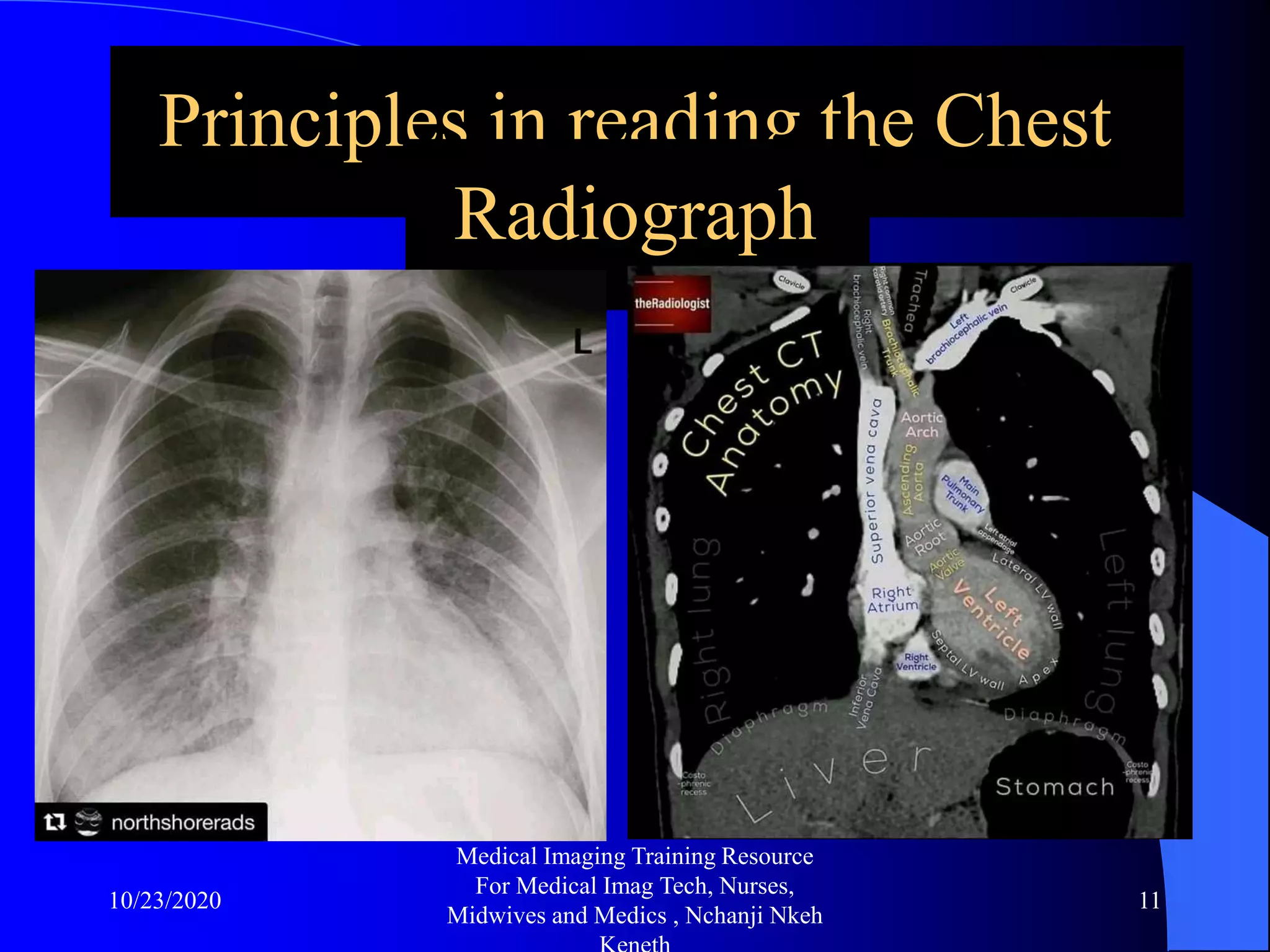 Chest x ray cxr and pathologies radiology training resource nchanji nkeh keneth | PDF | Lung and ...