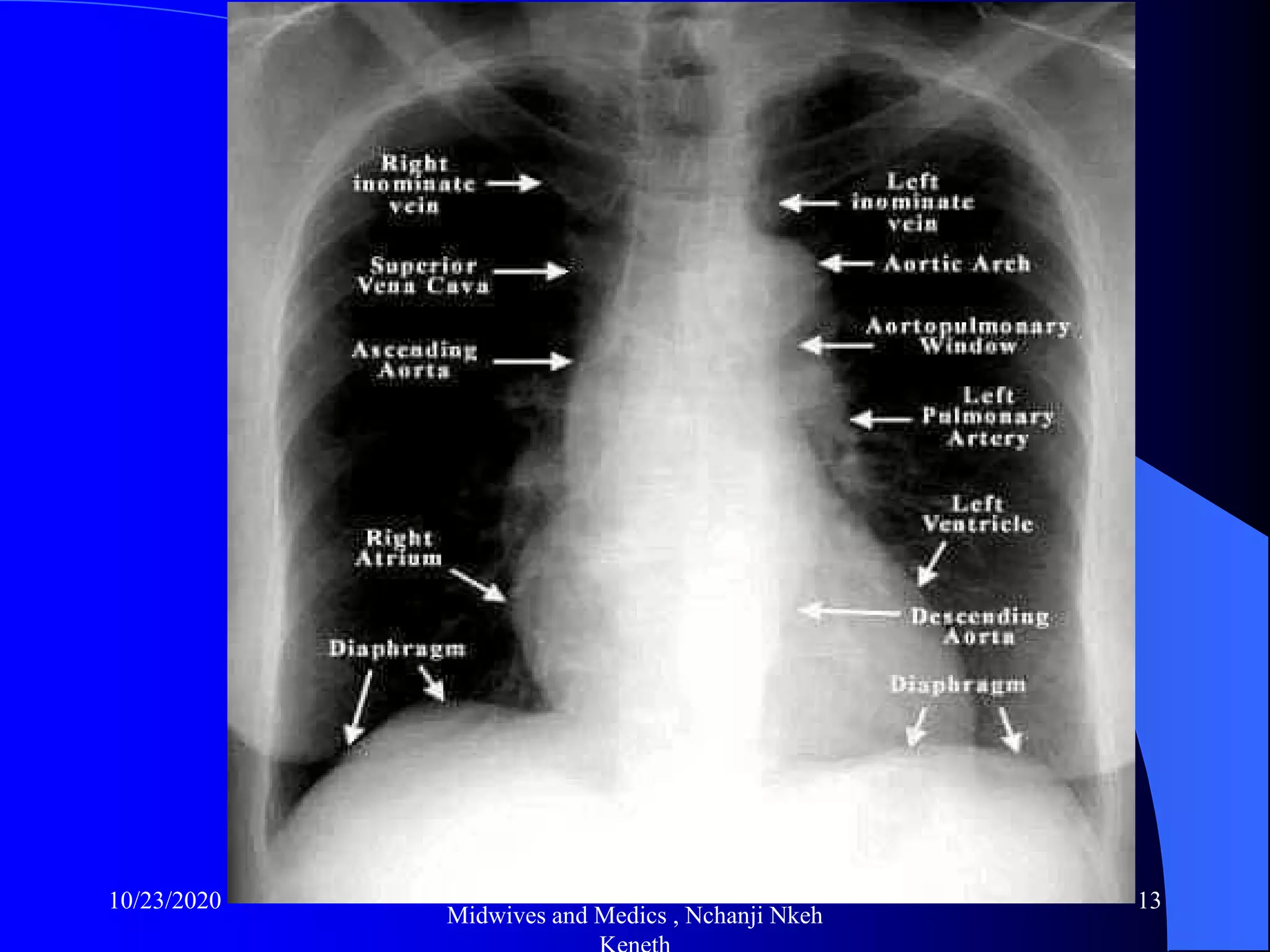 Chest x ray cxr and pathologies radiology training resource nchanji ...