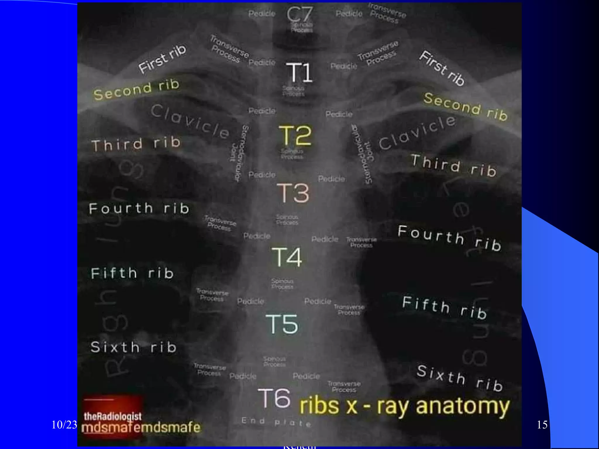Chest x ray cxr and pathologies radiology training resource nchanji ...