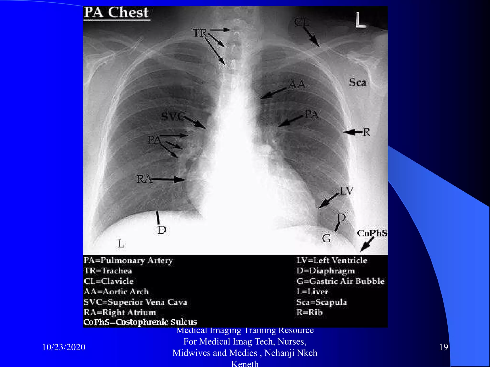Chest x ray cxr and pathologies radiology training resource nchanji ...