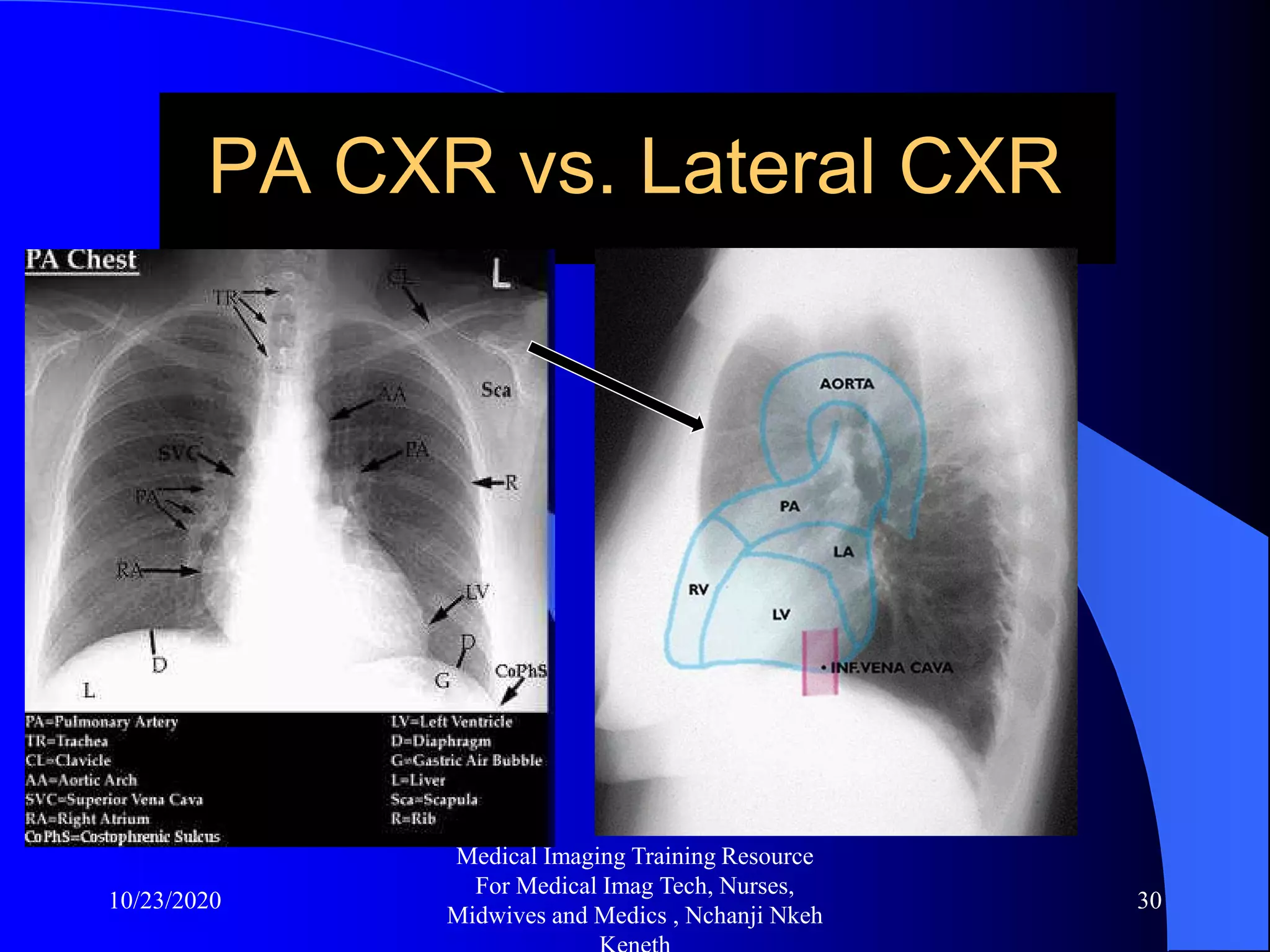 Chest x ray cxr and pathologies radiology training resource nchanji ...
