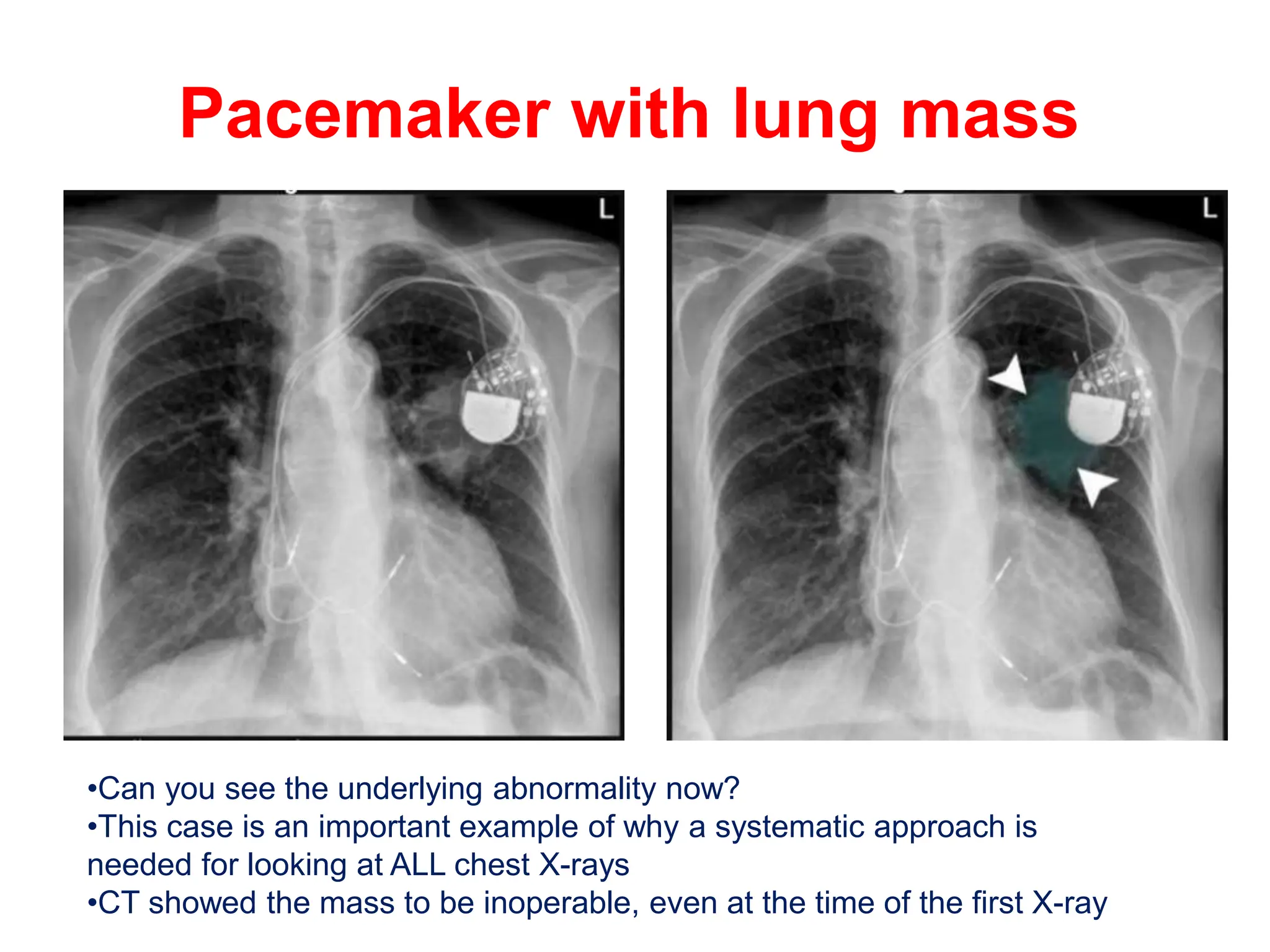 CHEST X-RAY DEVICES AND ARTIFACTS pptx.pptx