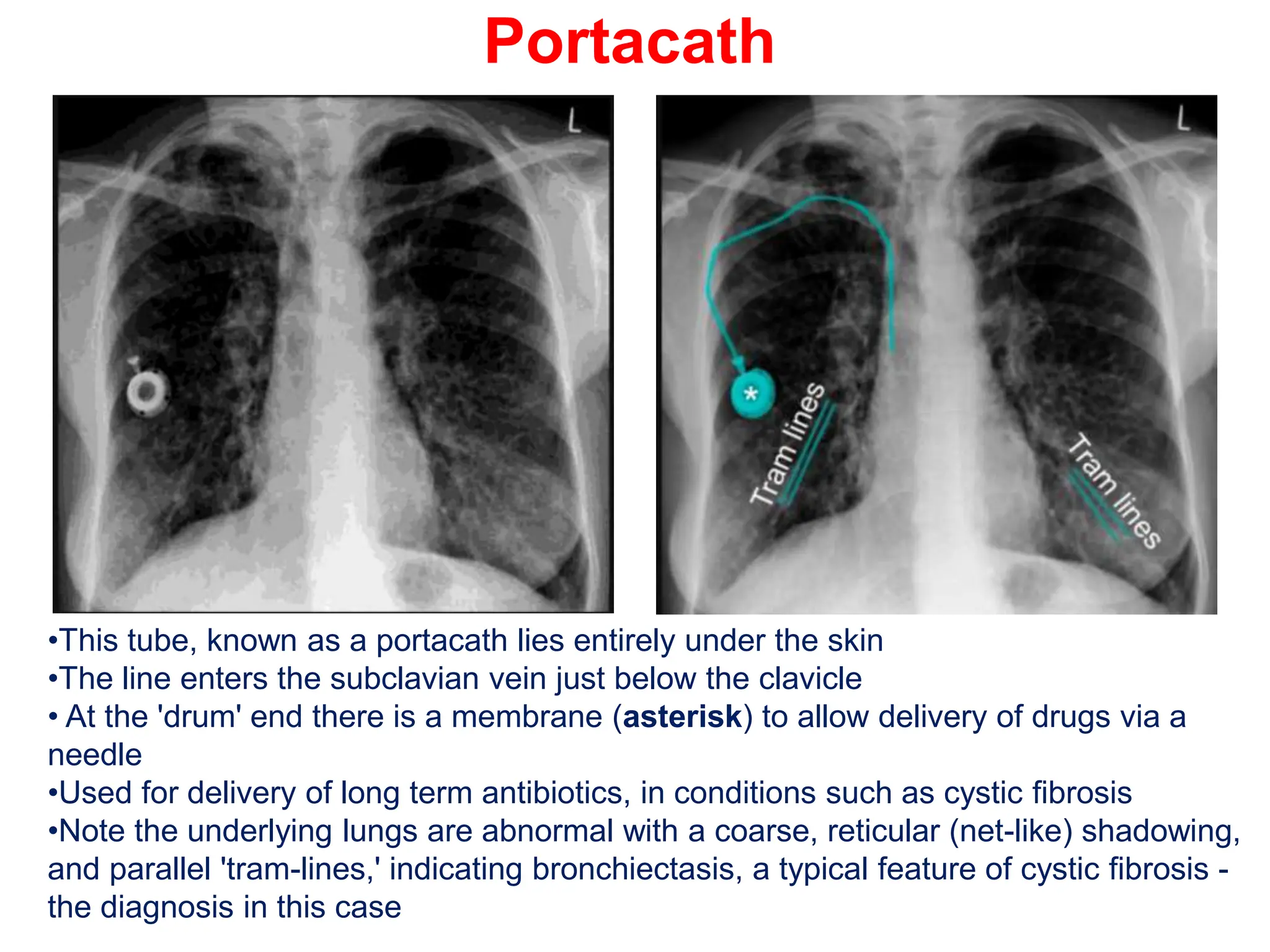 CHEST X-RAY DEVICES AND ARTIFACTS pptx.pptx