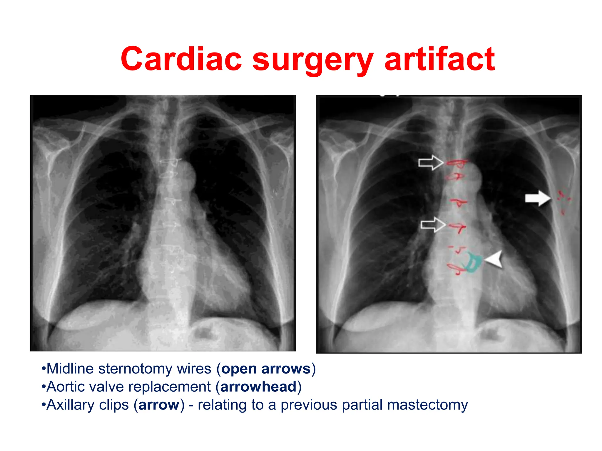 CHEST X-RAY DEVICES AND ARTIFACTS pptx.pptx