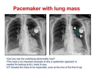 CHEST X-RAY DEVICES AND ARTIFACTS pptx.pptx