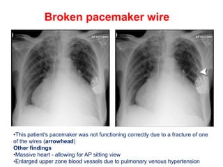 CHEST X-RAY DEVICES AND ARTIFACTS pptx.pptx