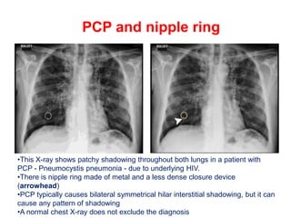CHEST X-RAY DEVICES AND ARTIFACTS pptx.pptx