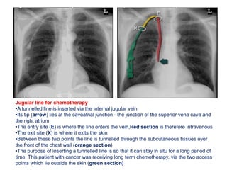 CHEST X-RAY DEVICES AND ARTIFACTS pptx.pptx