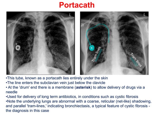 CHEST X-RAY DEVICES AND ARTIFACTS pptx.pptx