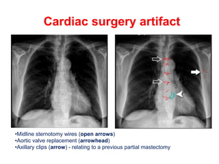 CHEST X-RAY DEVICES AND ARTIFACTS pptx.pptx