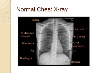 CHEST X-RAY F.pptx