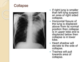 CHEST X-RAY F.pptx