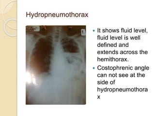 CHEST X-RAY F.pptx
