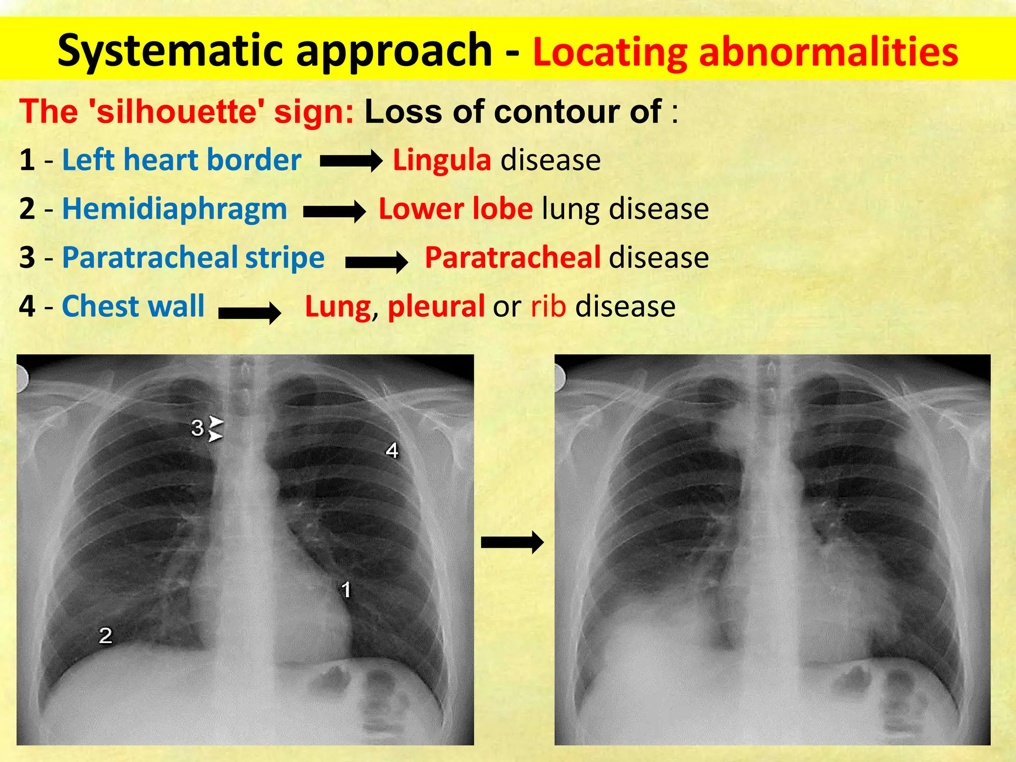 Chest X-ray Fundamentals on Acquisition and Interpretation.pdf