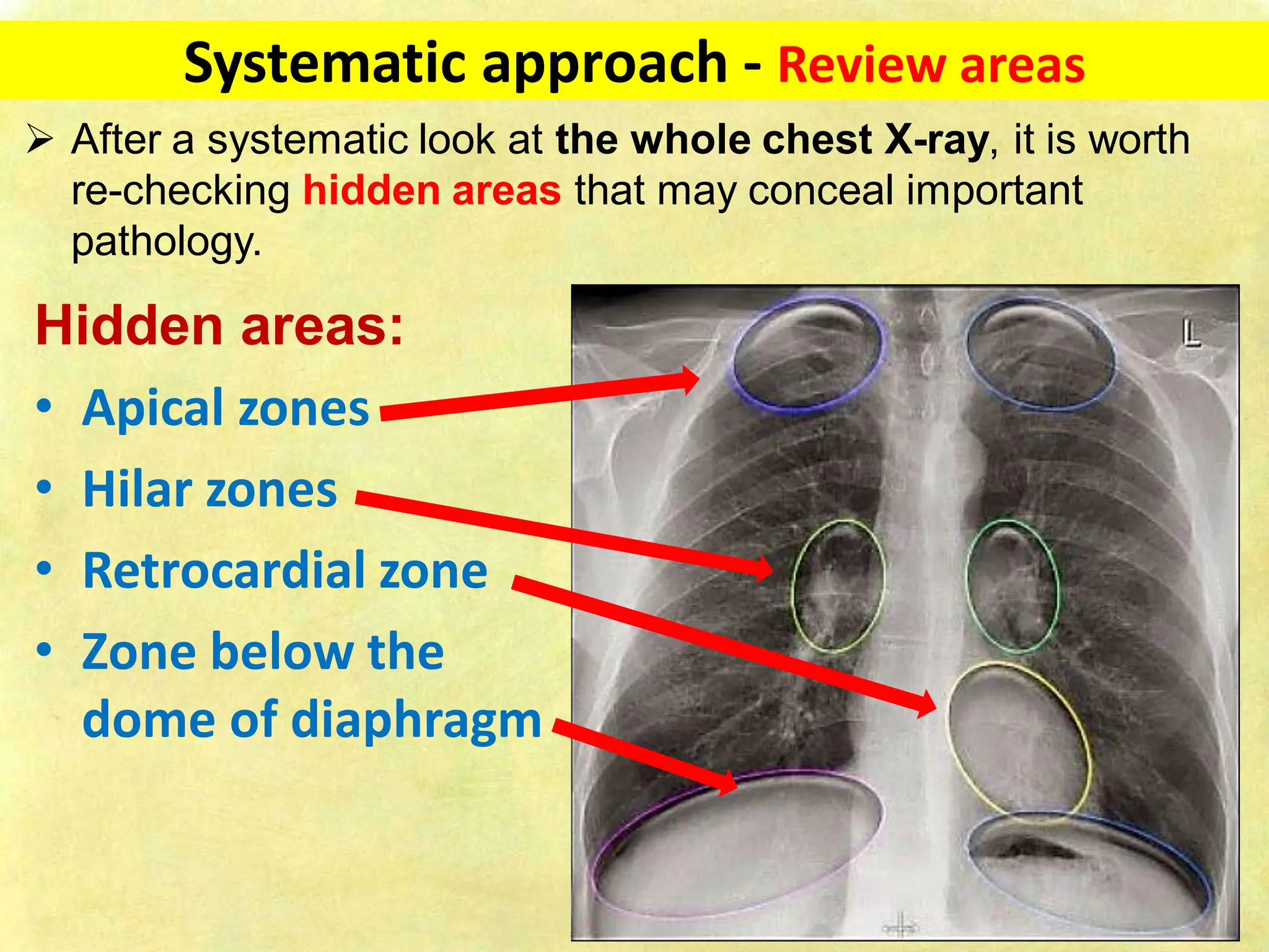 Chest X-ray Fundamentals on Acquisition and Interpretation.pdf