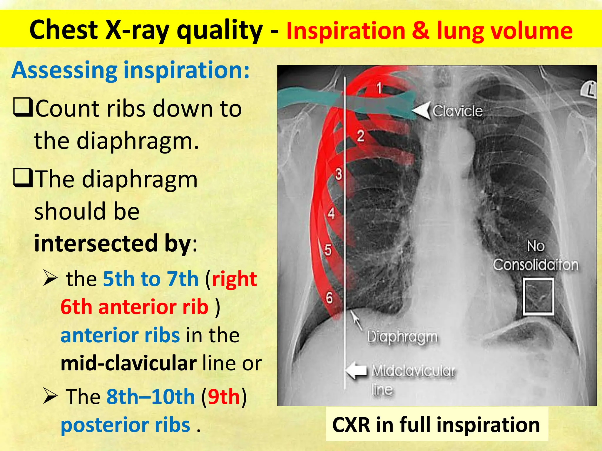 Chest X-ray Fundamentals on Acquisition and Interpretation.pdf