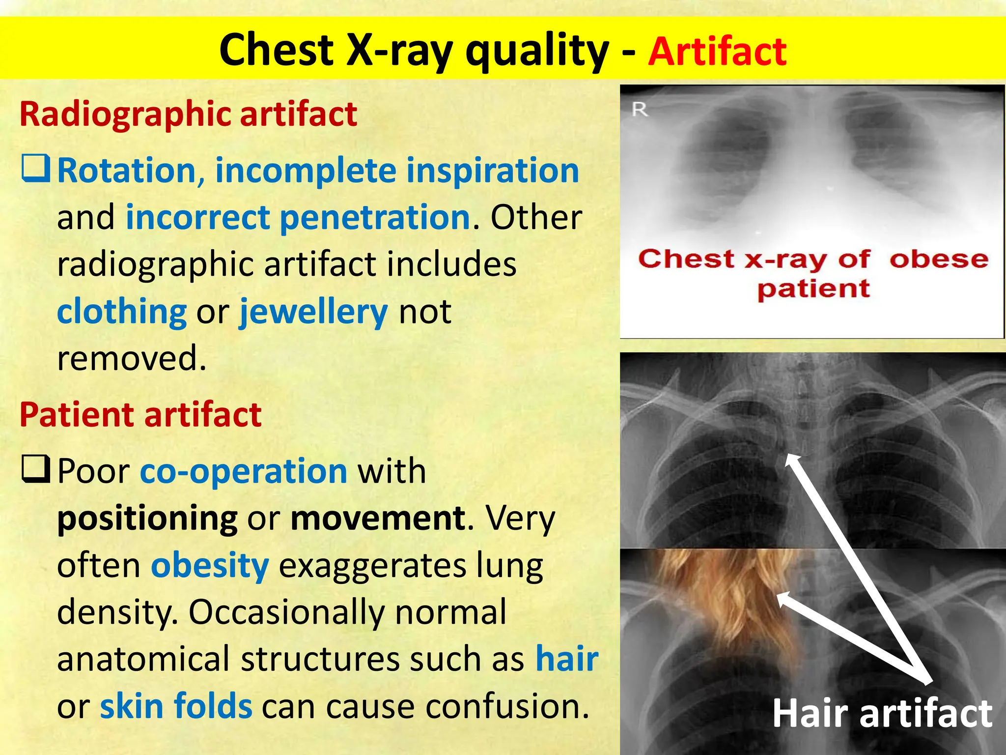 Chest X-ray Fundamentals on Acquisition and Interpretation.pdf