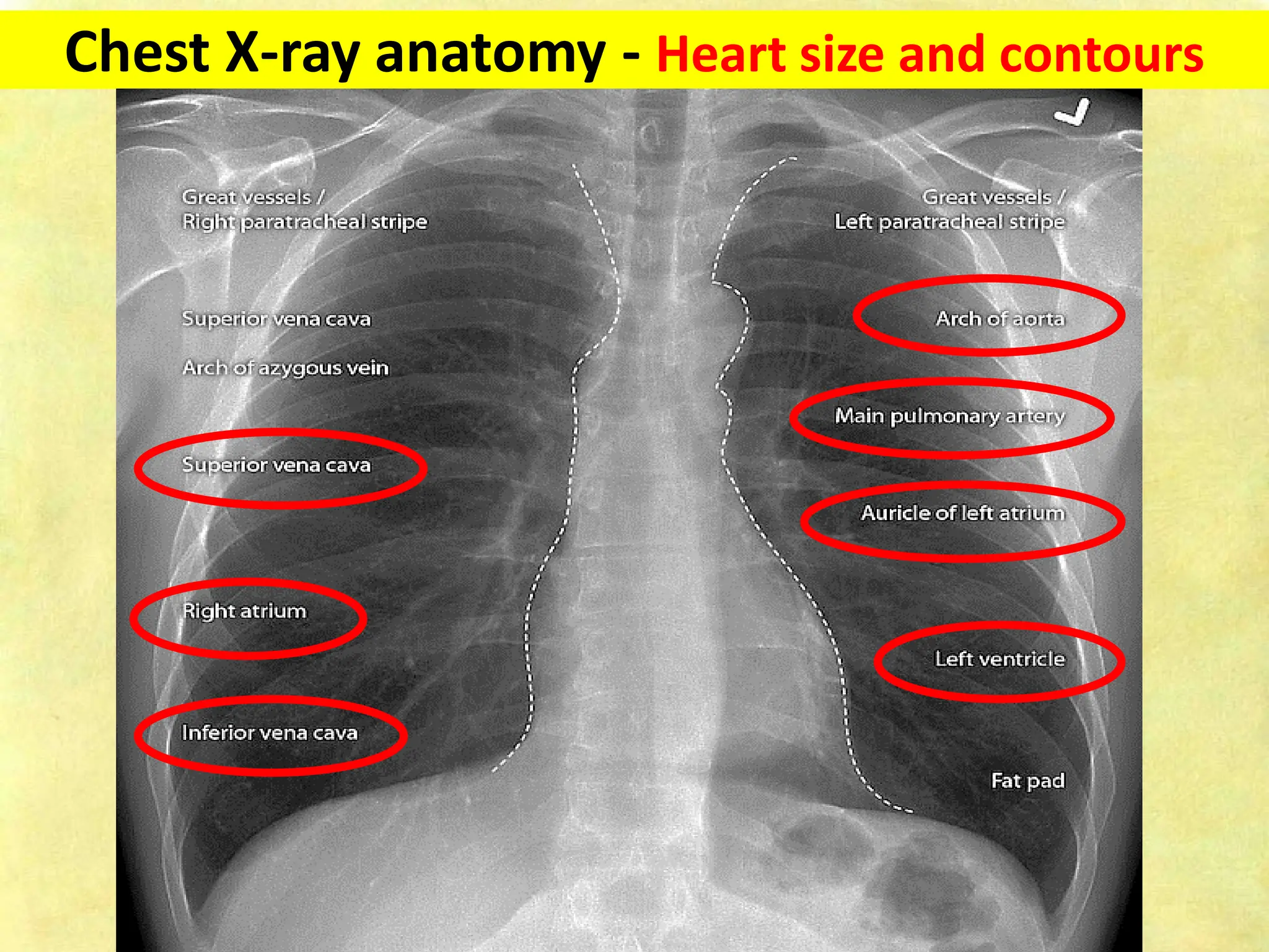 Chest X-ray Fundamentals on Acquisition and Interpretation.pdf