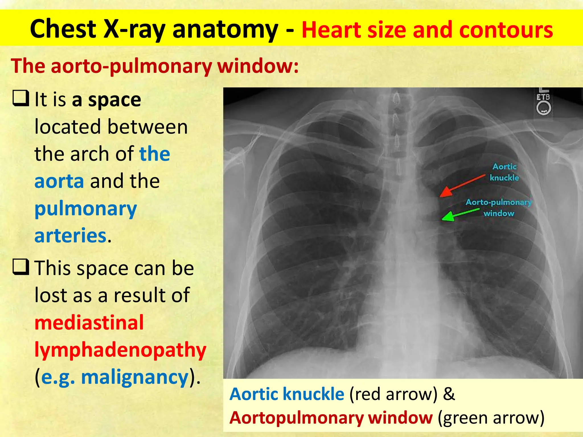 Chest X-ray Fundamentals on Acquisition and Interpretation.pdf
