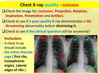 Chest X-ray Fundamentals on Acquisition and Interpretation.pdf
