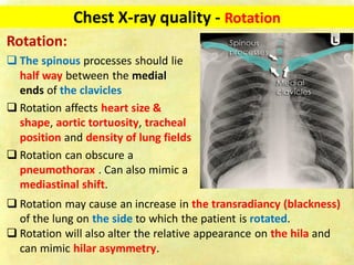 Chest X-ray Fundamentals on Acquisition and Interpretation.pdf