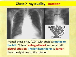 Chest X-ray Fundamentals on Acquisition and Interpretation.pdf