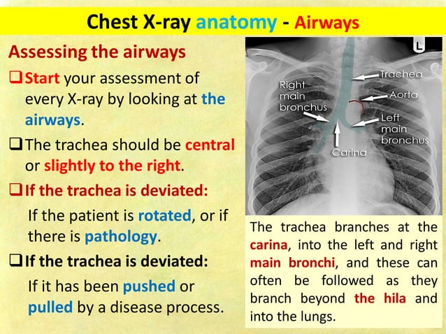 Chest X-ray Fundamentals on Acquisition and Interpretation.pdf