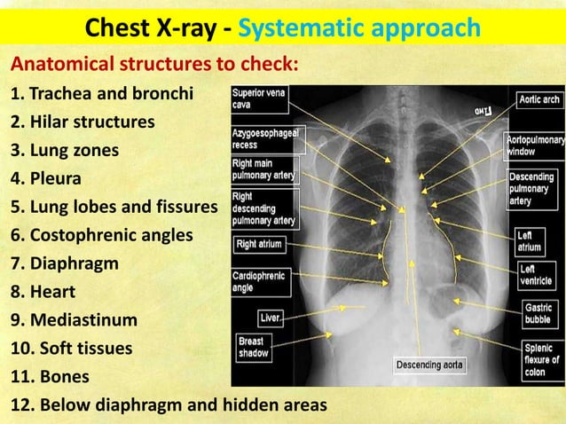 Chest X-ray Fundamentals on Acquisition and Interpretation.pdf
