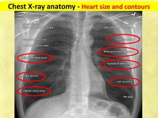 Chest X-ray Fundamentals on Acquisition and Interpretation.pdf | Lung ...