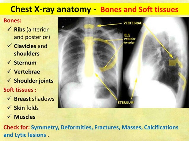 Chest X-ray Fundamentals on Acquisition and Interpretation.pdf