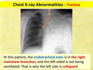 Chest X-ray Fundamentals on Acquisition and Interpretation.pdf