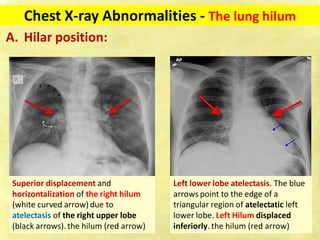 Chest X-ray Fundamentals on Acquisition and Interpretation.pdf