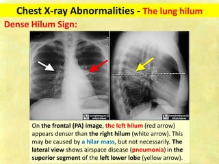 Chest X-ray Fundamentals on Acquisition and Interpretation.pdf | Lung ...