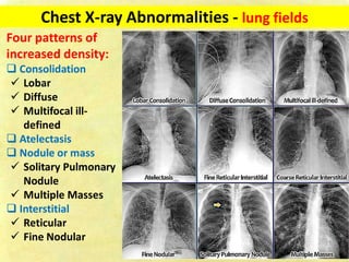Chest X-ray Fundamentals on Acquisition and Interpretation.pdf