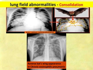 Chest X-ray Fundamentals on Acquisition and Interpretation.pdf
