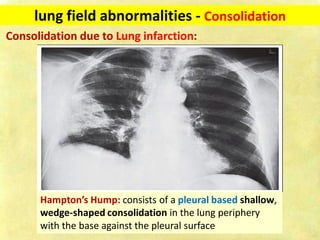 Chest X-ray Fundamentals on Acquisition and Interpretation.pdf