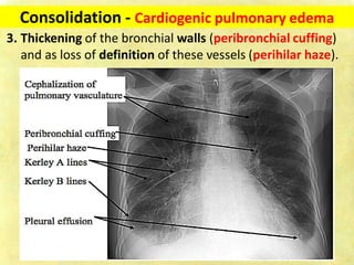 Chest X-ray Fundamentals on Acquisition and Interpretation.pdf