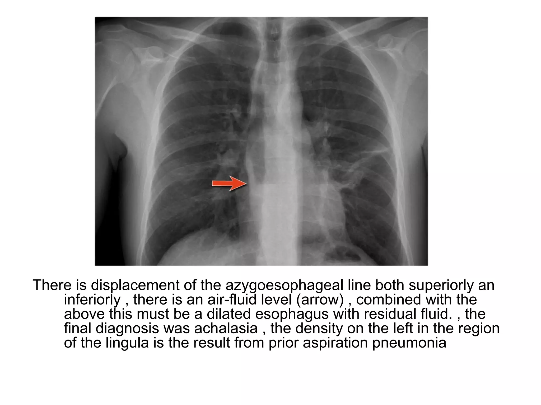 Chest X-rays Basic Interpretation | PPT