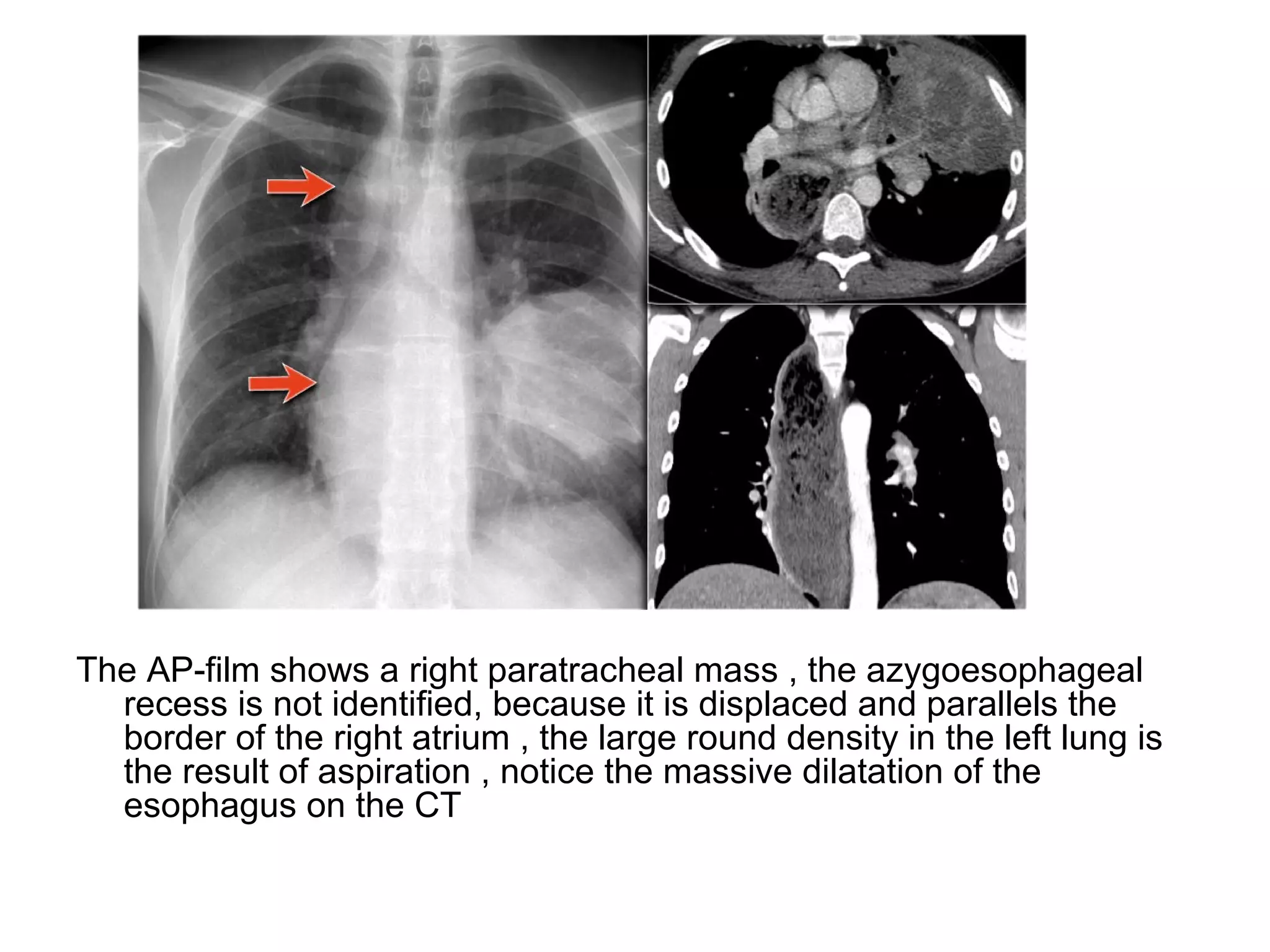 Chest X-rays Basic Interpretation | PPT