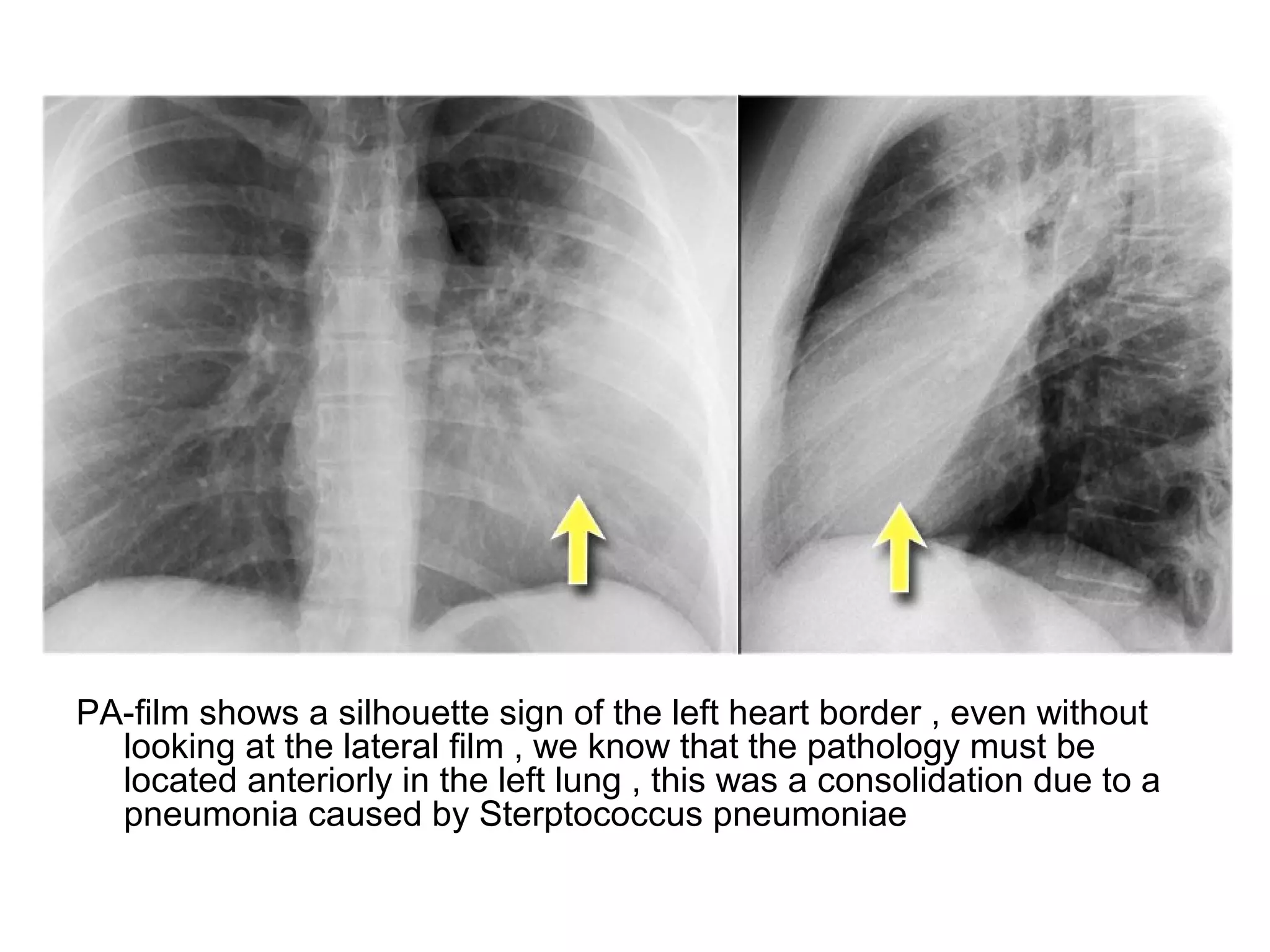 Chest X-rays Basic Interpretation | PPT